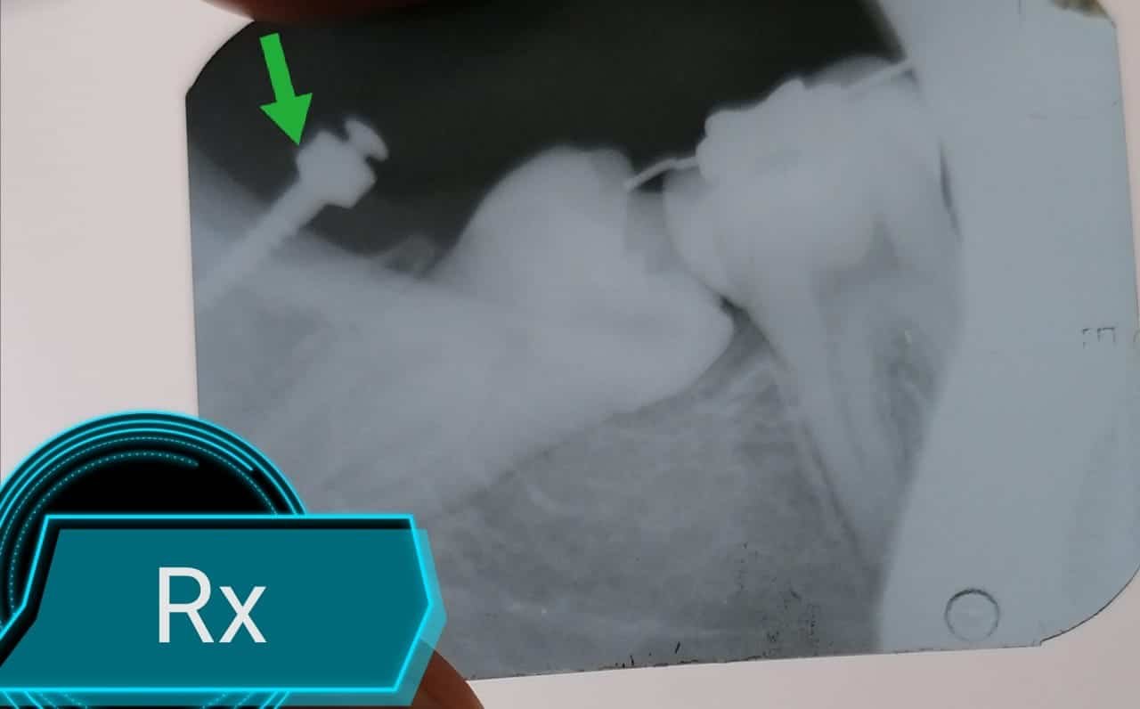Mini implantes en Ortodoncia ¿Cuándo se usan? Opción#1